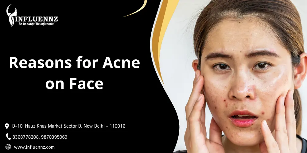 Acne Reasons