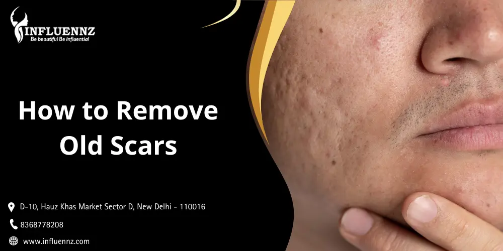 How to Remove Old Scars: Best Treatments for Acne, Injury & Pigmented Scars