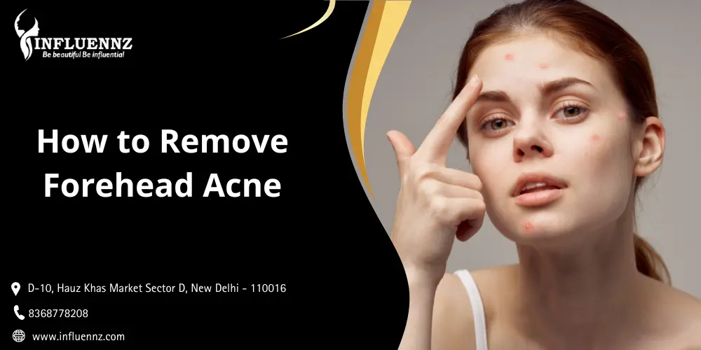 How to Remove Forehead Acne: Treatment & Fast Relief Tips