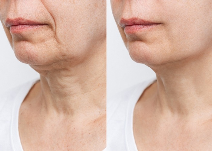 Nefertiti Neck Lift Treatment in Delhi - Influennz Clinic