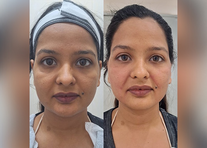 Thread Lift Treatment in Delhi – Non-Surgical Face Lift